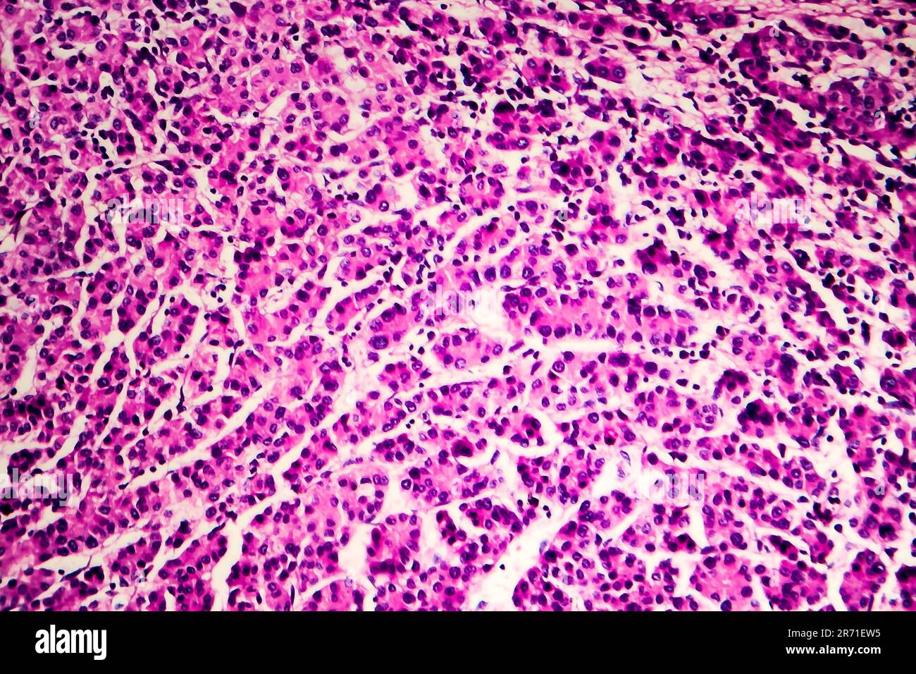 Hepatocellular carcinoma, cancer of liver, light micrograph, photo ...