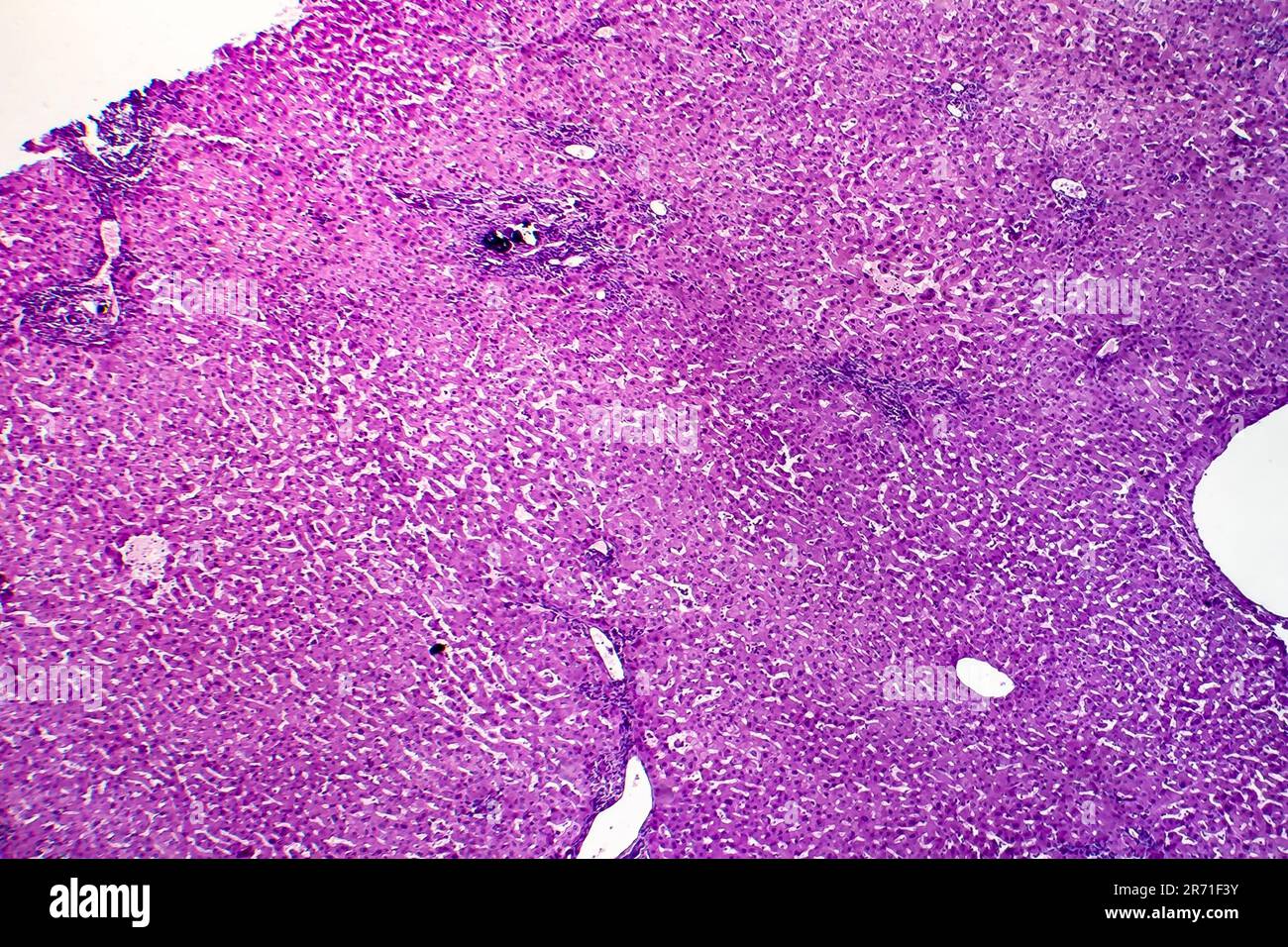 Liver schistosomiasis, light micrograph, photo under microscope showing ...