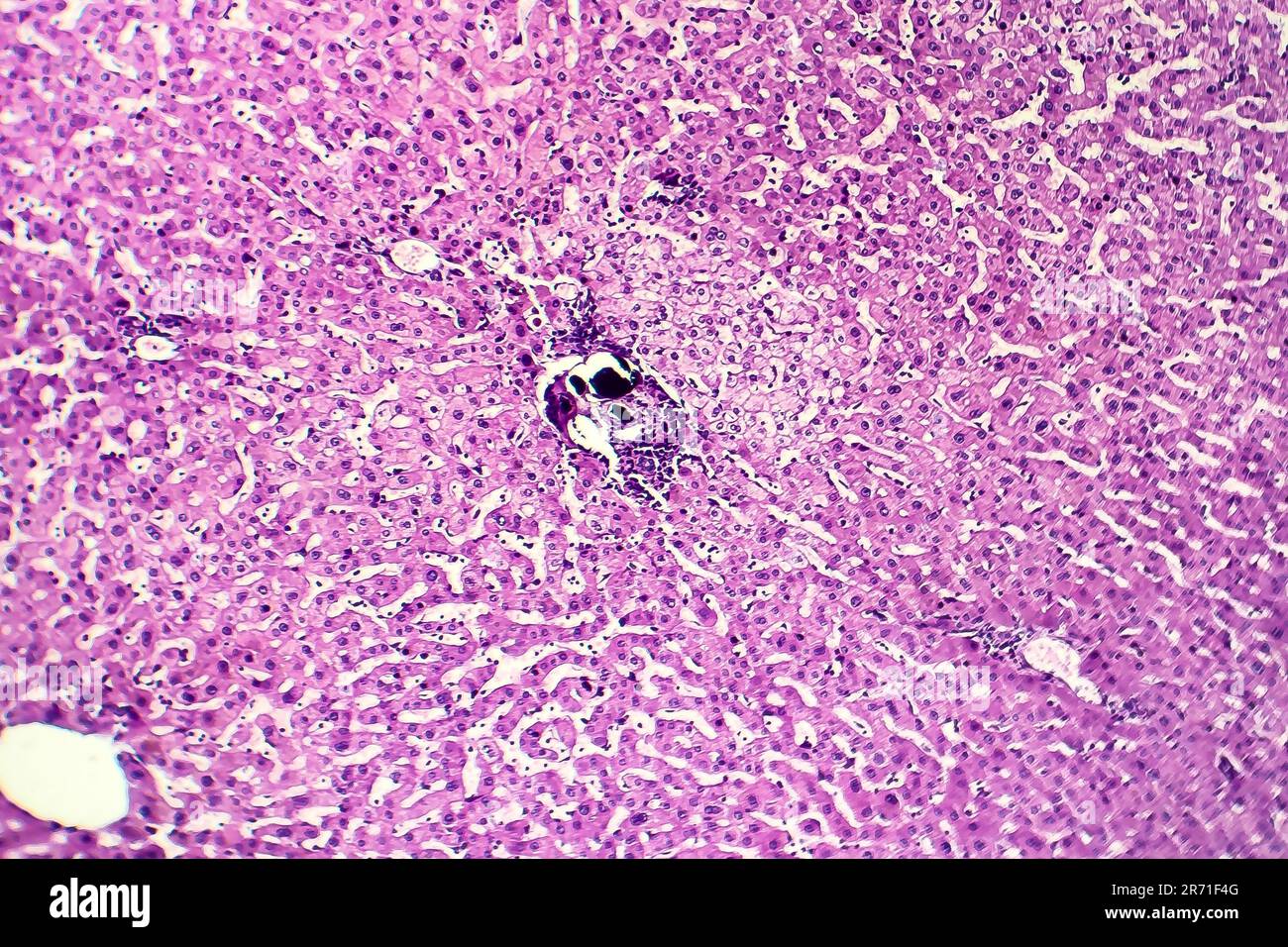 Liver schistosomiasis, light micrograph, photo under microscope showing ...