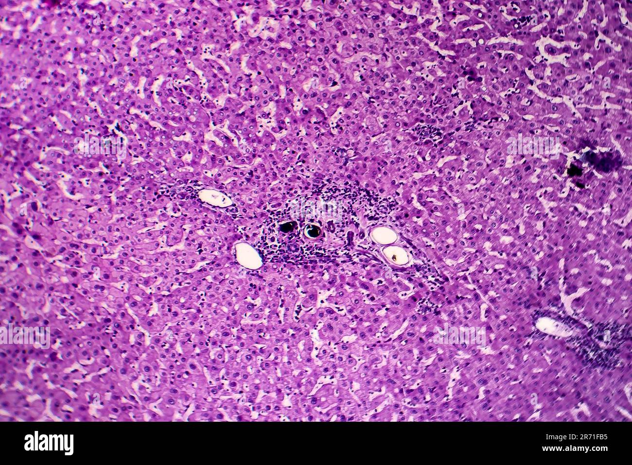 Liver schistosomiasis, light micrograph, photo under microscope showing ...