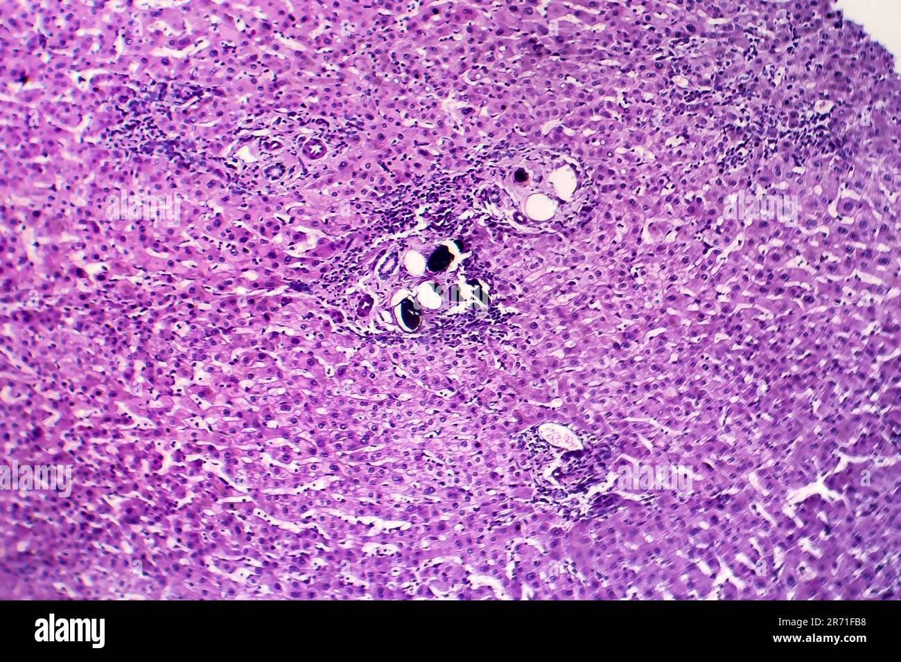 Liver schistosomiasis, light micrograph, photo under microscope showing ...