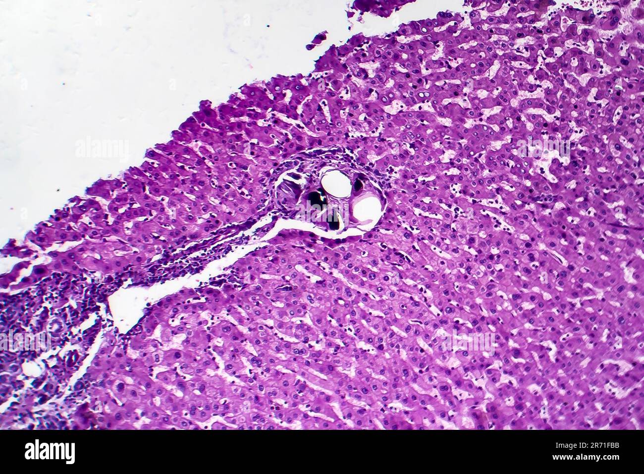 Liver schistosomiasis, light micrograph, photo under microscope showing ...