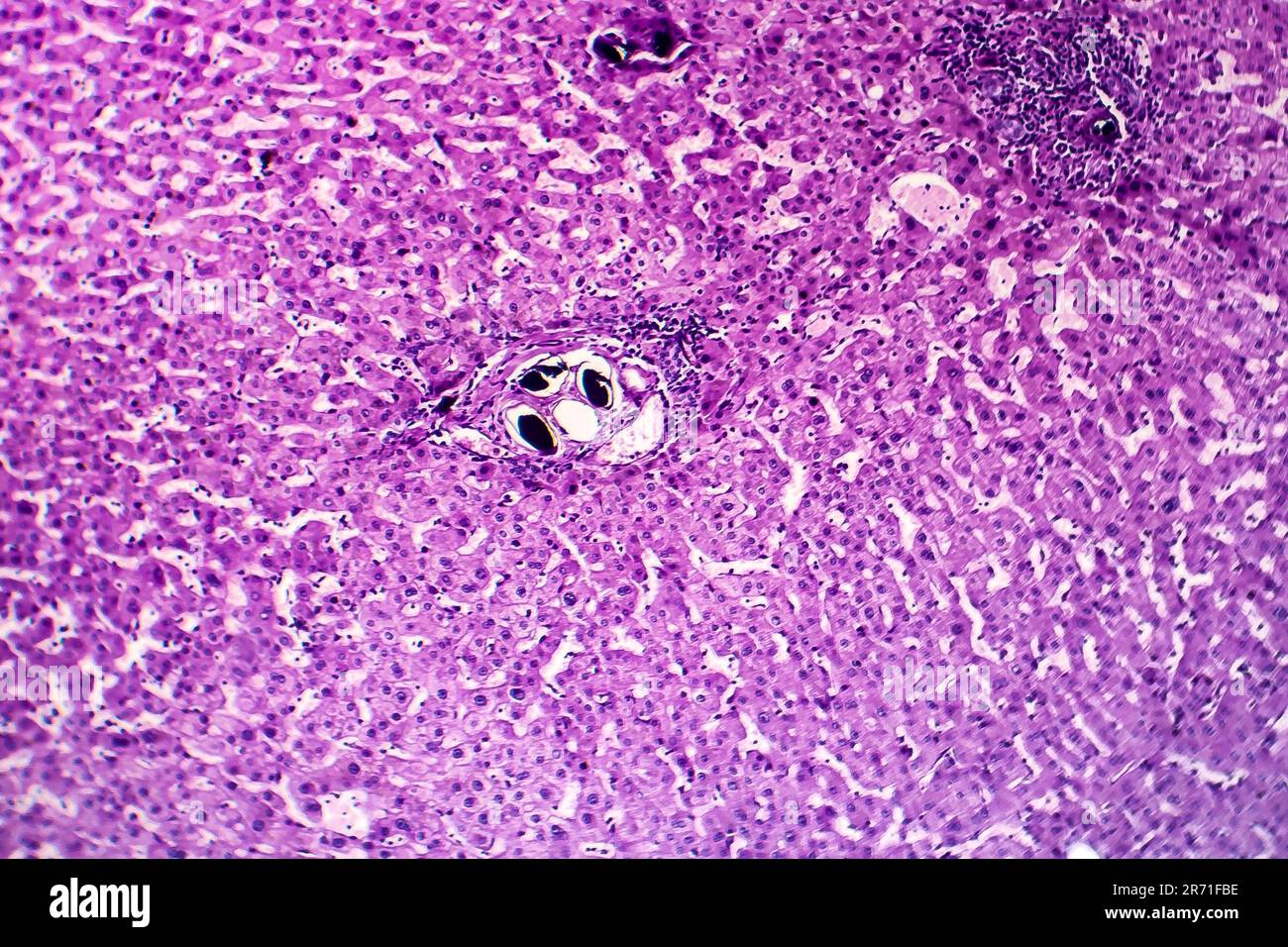 Liver schistosomiasis, light micrograph, photo under microscope showing ...