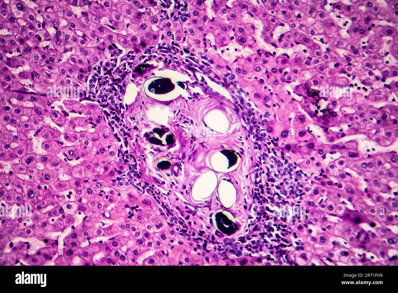 Liver schistosomiasis, light micrograph, photo under microscope showing ...