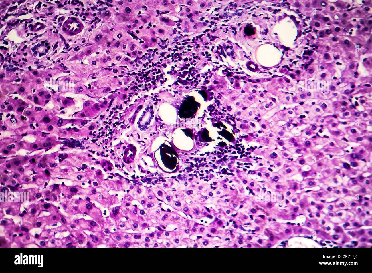 Liver schistosomiasis, light micrograph, photo under microscope showing ...