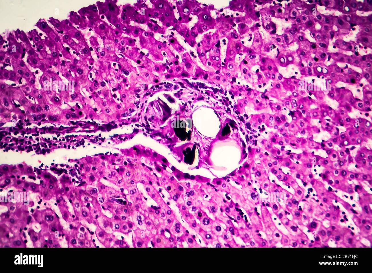 Liver schistosomiasis, light micrograph, photo under microscope showing ...