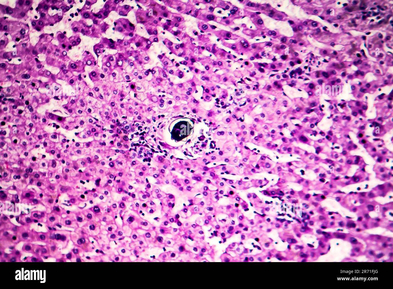 Liver schistosomiasis, light micrograph, photo under microscope showing ...