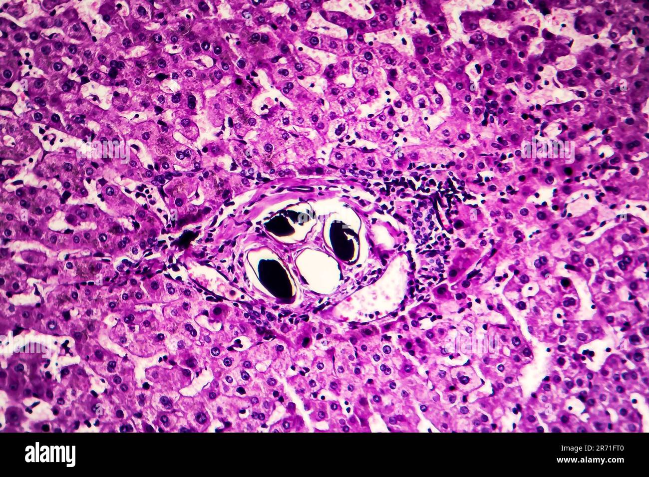 Liver schistosomiasis, light micrograph, photo under microscope showing ...