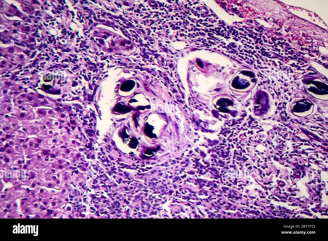 Liver schistosomiasis, light micrograph, photo under microscope showing presence of Schistosoma ...