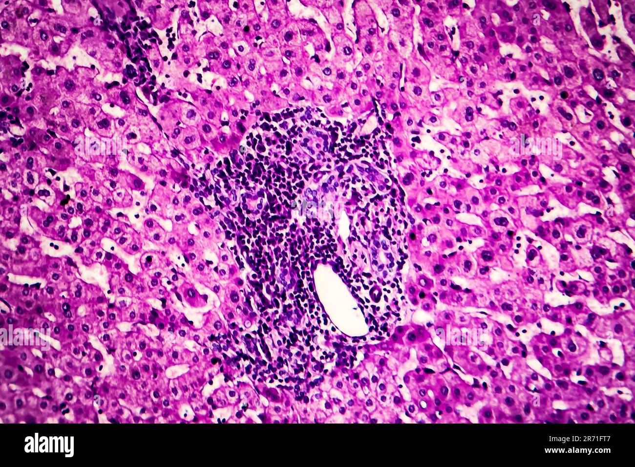 Liver schistosomiasis, light micrograph, photo under microscope showing ...