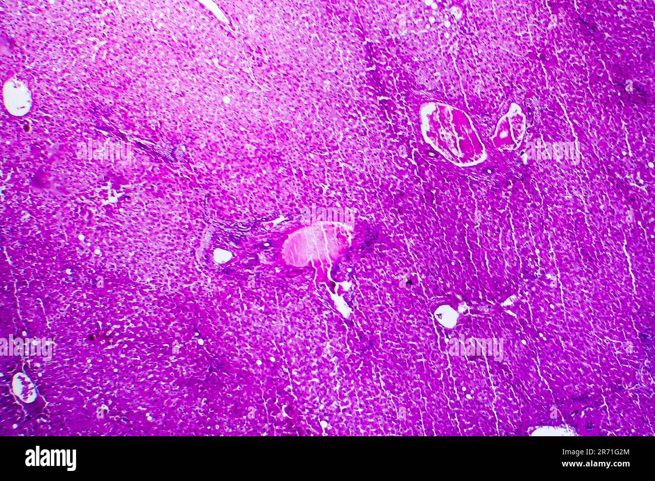 Liver edema, light micrograph, photo under microscope Stock Photo - Alamy