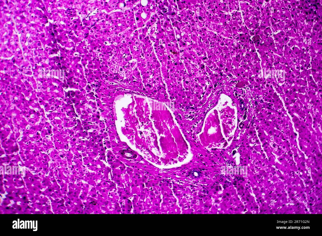Liver edema, light micrograph, photo under microscope Stock Photo - Alamy