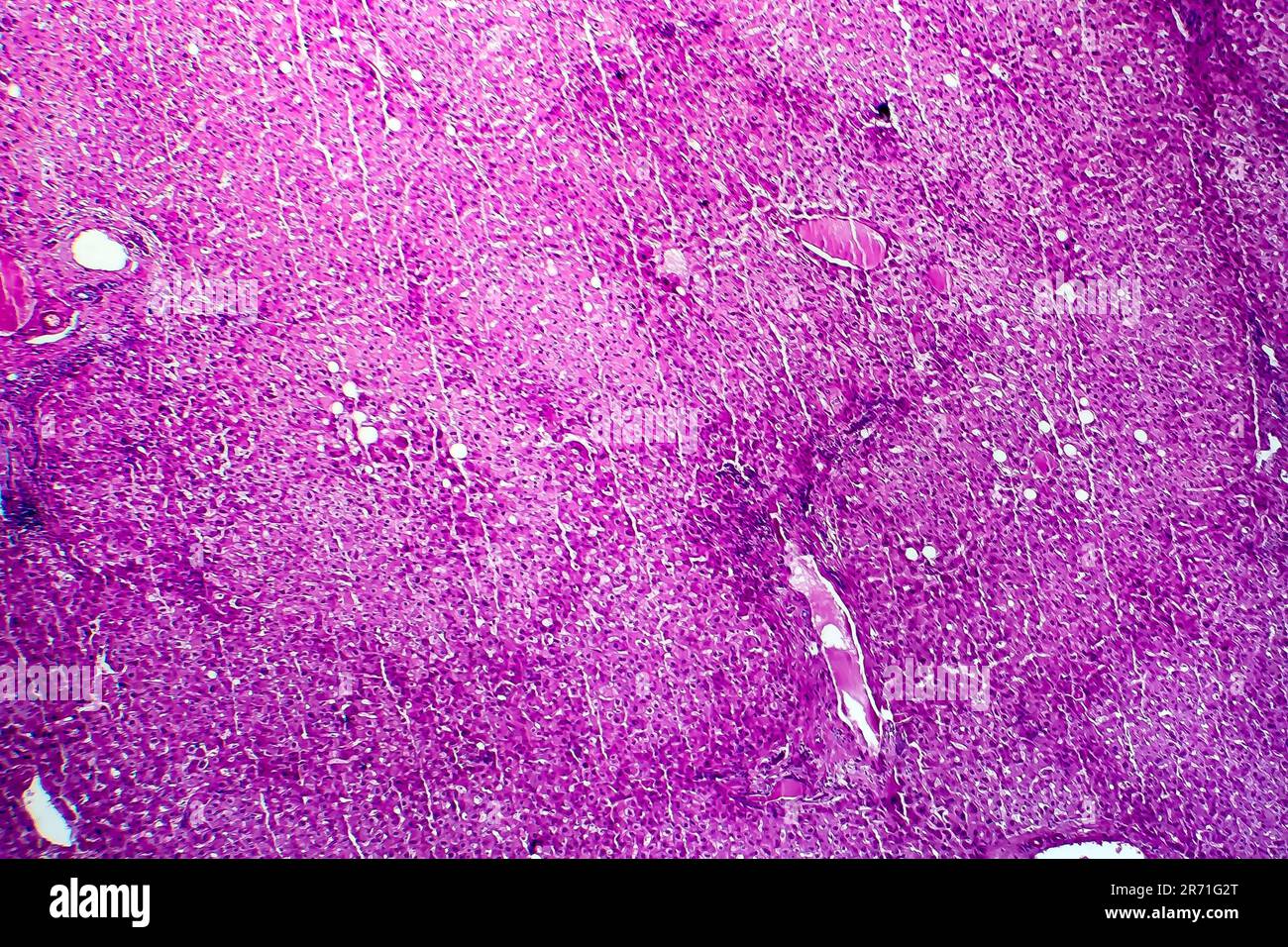 Liver edema, light micrograph, photo under microscope Stock Photo - Alamy