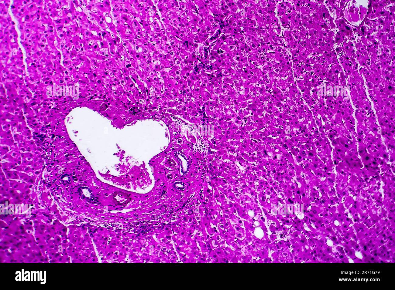 Liver edema, light micrograph, photo under microscope Stock Photo - Alamy