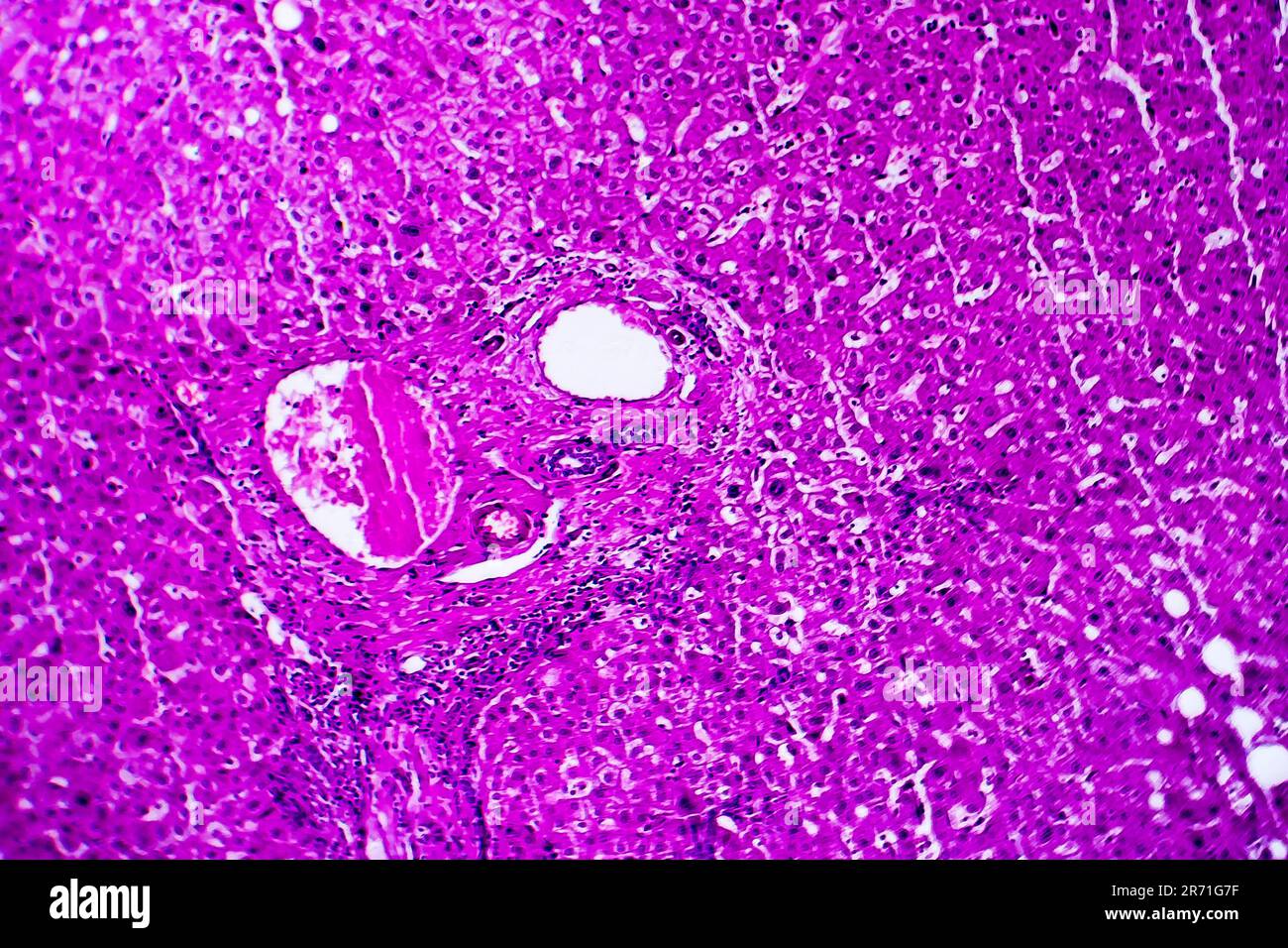 Liver edema, light micrograph, photo under microscope Stock Photo - Alamy