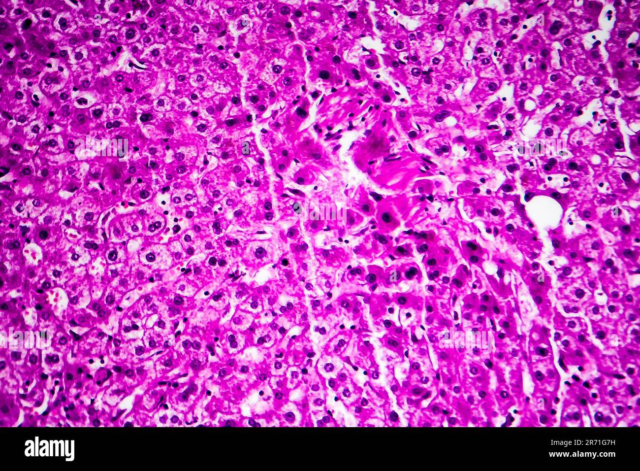 Liver edema, light micrograph, photo under microscope Stock Photo - Alamy