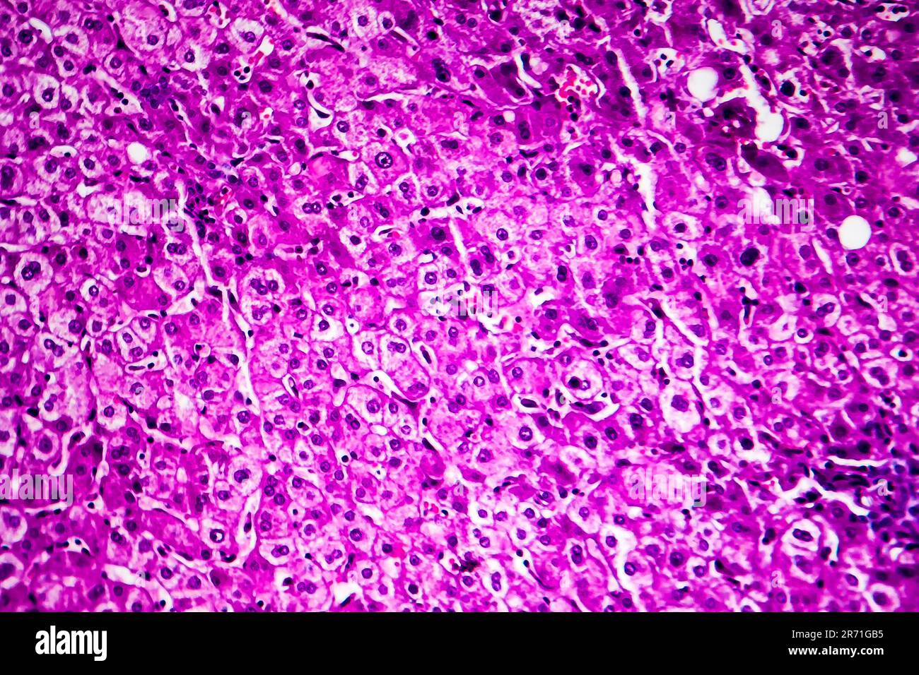Liver edema, light micrograph, photo under microscope Stock Photo - Alamy