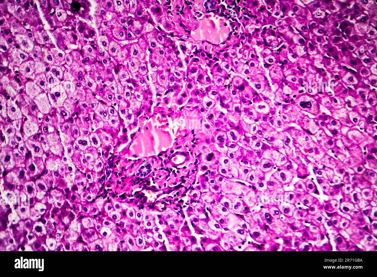 Liver edema, light micrograph, photo under microscope Stock Photo - Alamy