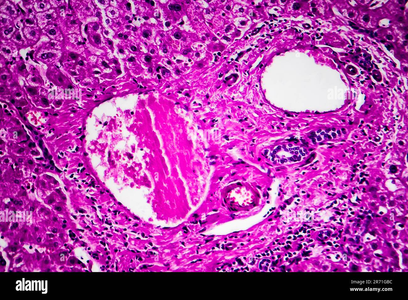 Liver edema, light micrograph, photo under microscope Stock Photo - Alamy