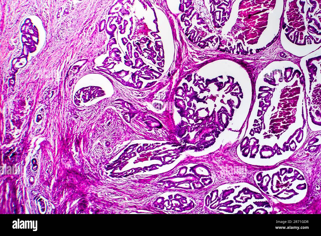Well-differentiated intestinal adenocarcinoma, light micrograph, photo ...