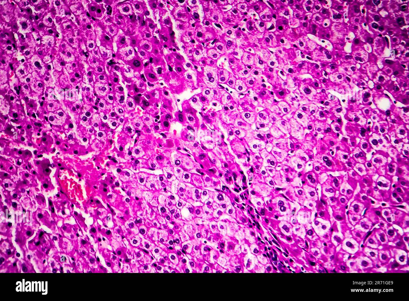 Liver edema, light micrograph, photo under microscope Stock Photo - Alamy