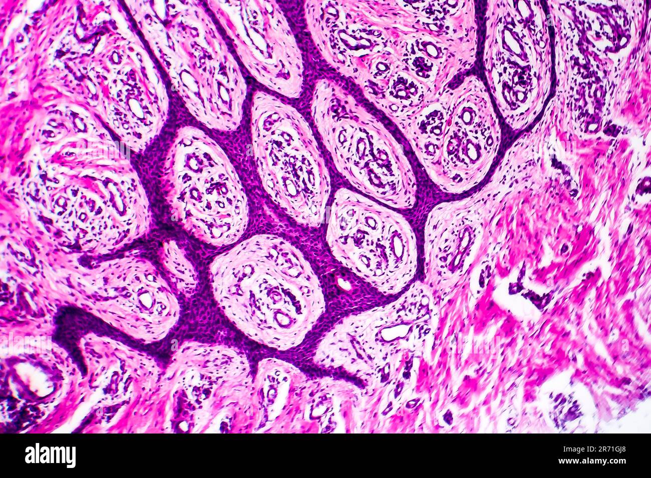 Well-differentiated intestinal adenocarcinoma, light micrograph, photo ...