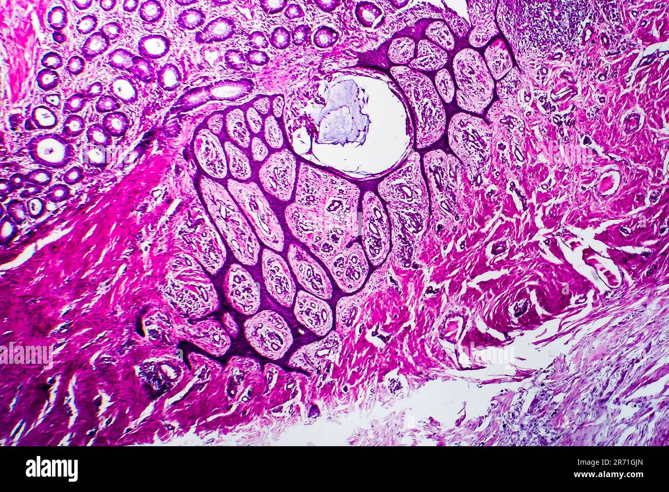 Well-differentiated intestinal adenocarcinoma, light micrograph, photo ...