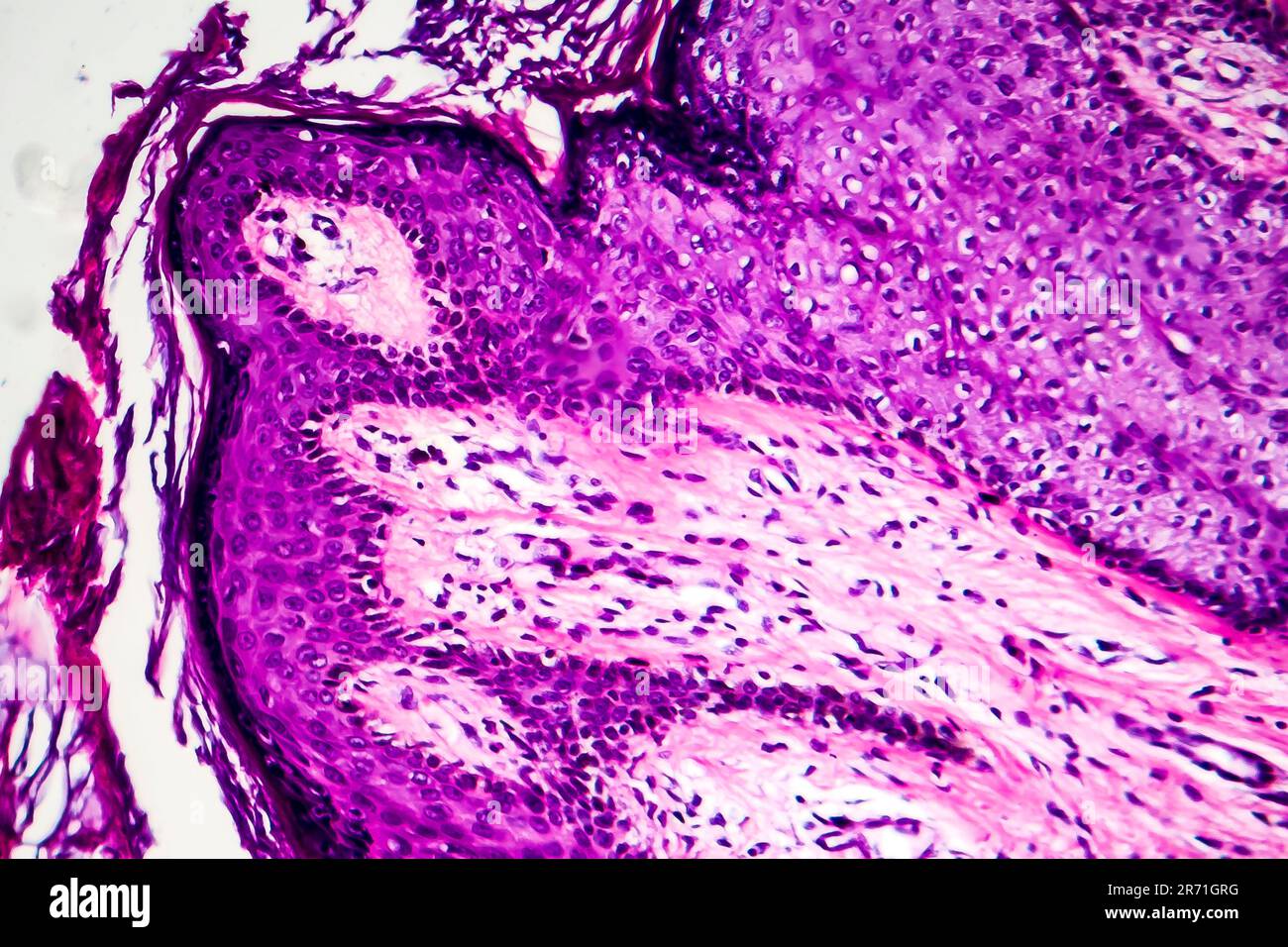 Well-differentiated intestinal adenocarcinoma, light micrograph, photo ...