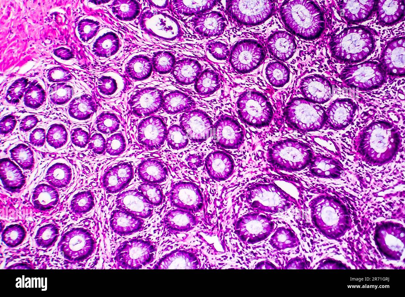 Well-differentiated intestinal adenocarcinoma, light micrograph, photo ...