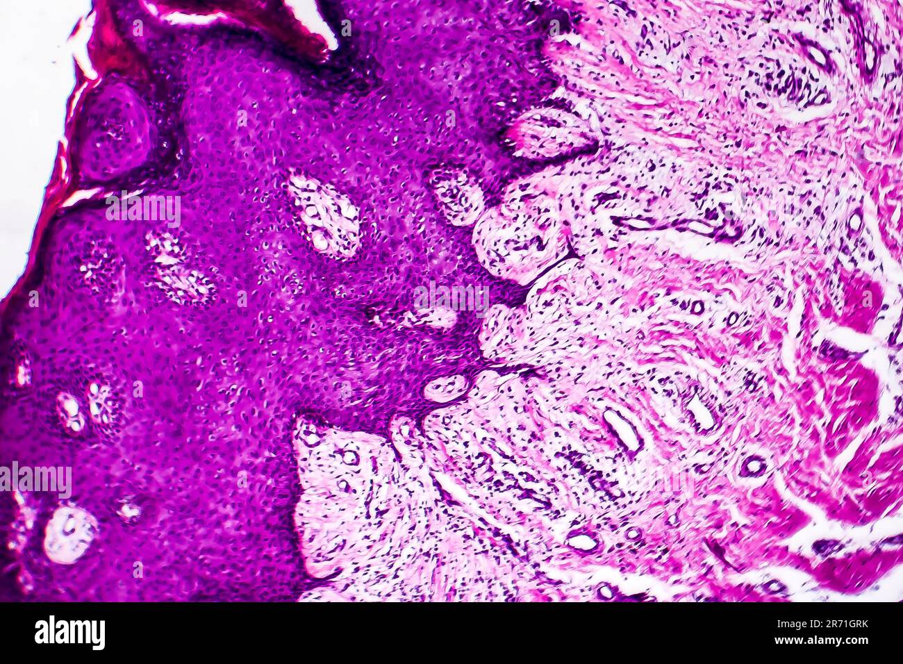 Well-differentiated intestinal adenocarcinoma, light micrograph, photo ...