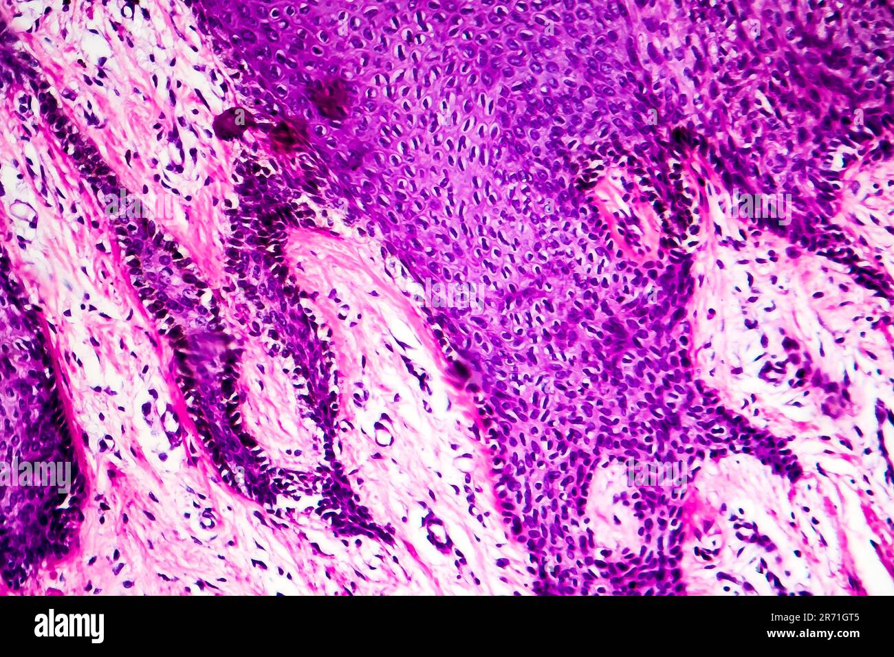 Well-differentiated intestinal adenocarcinoma, light micrograph, photo ...