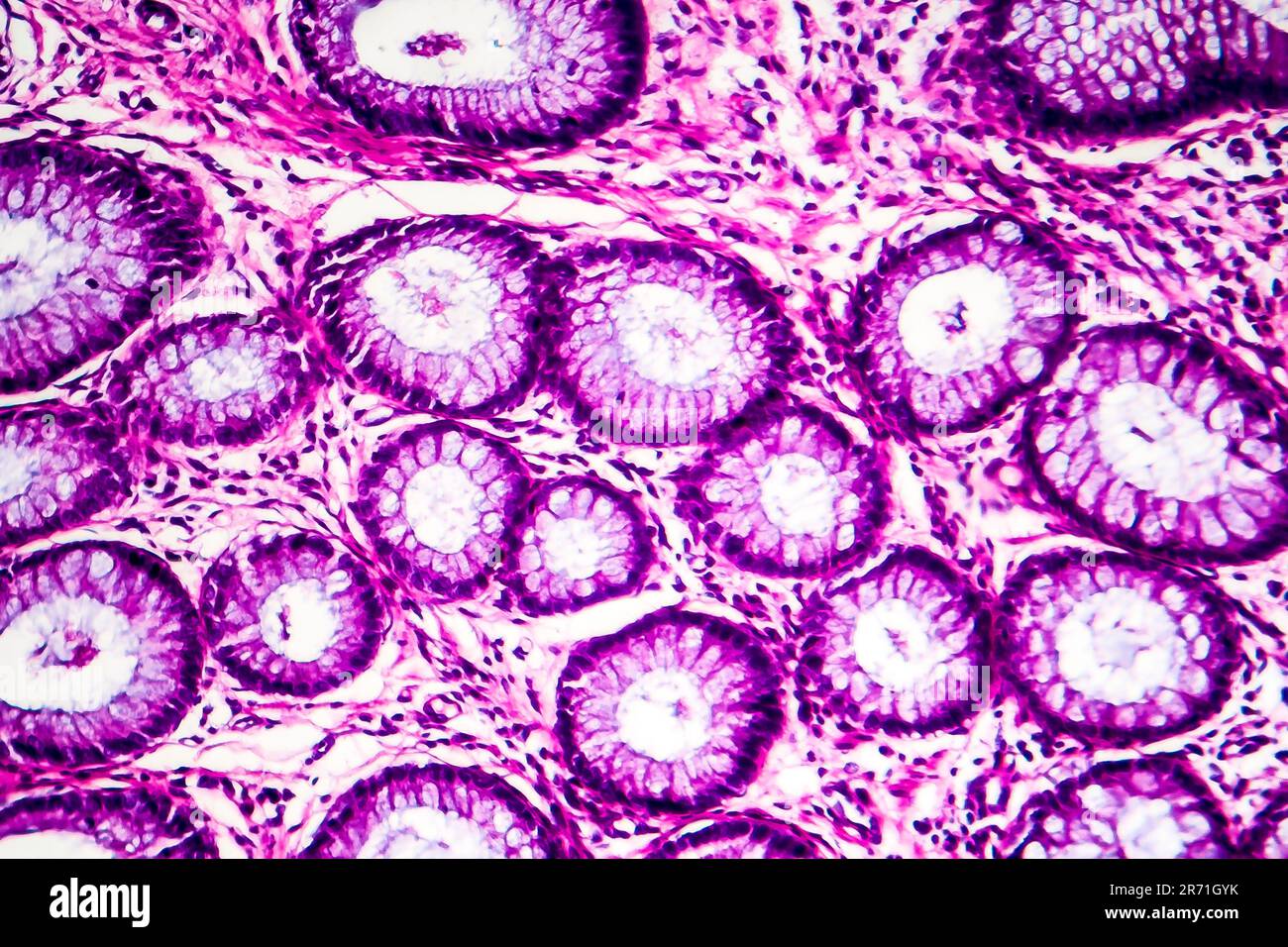 Well-differentiated intestinal adenocarcinoma, light micrograph, photo ...