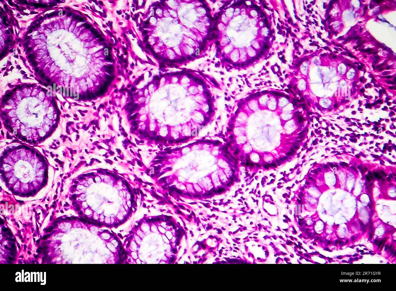 Well-differentiated intestinal adenocarcinoma, light micrograph, photo ...