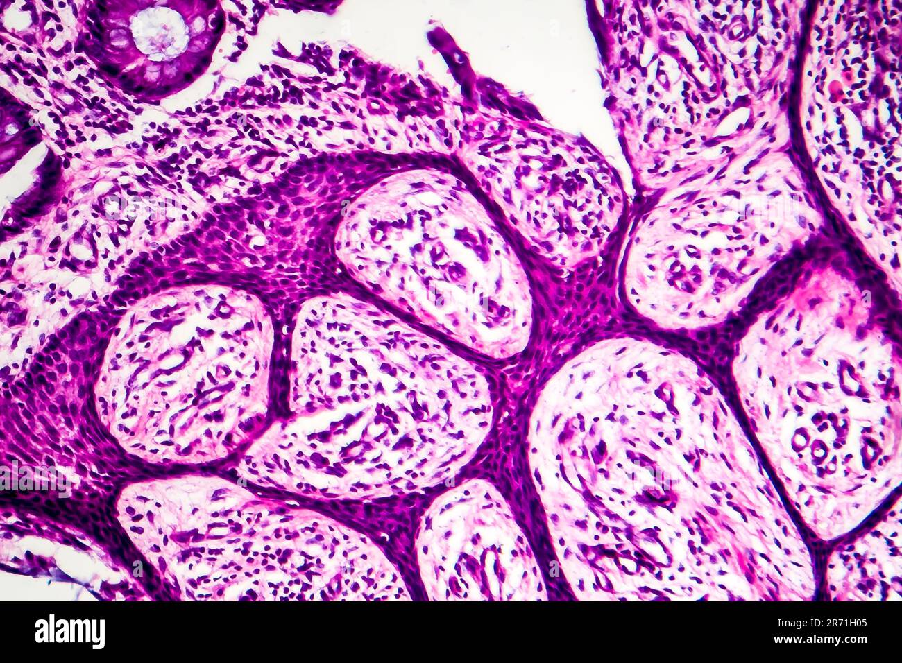 Well differentiated hi-res stock photography and images - Alamy