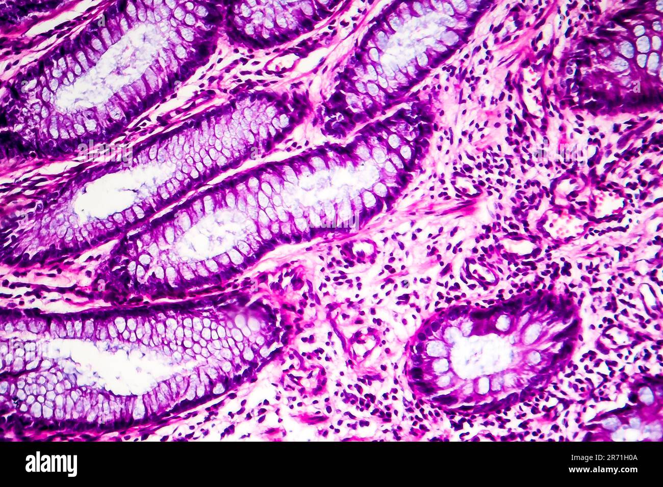 Well-differentiated intestinal adenocarcinoma, light micrograph, photo ...