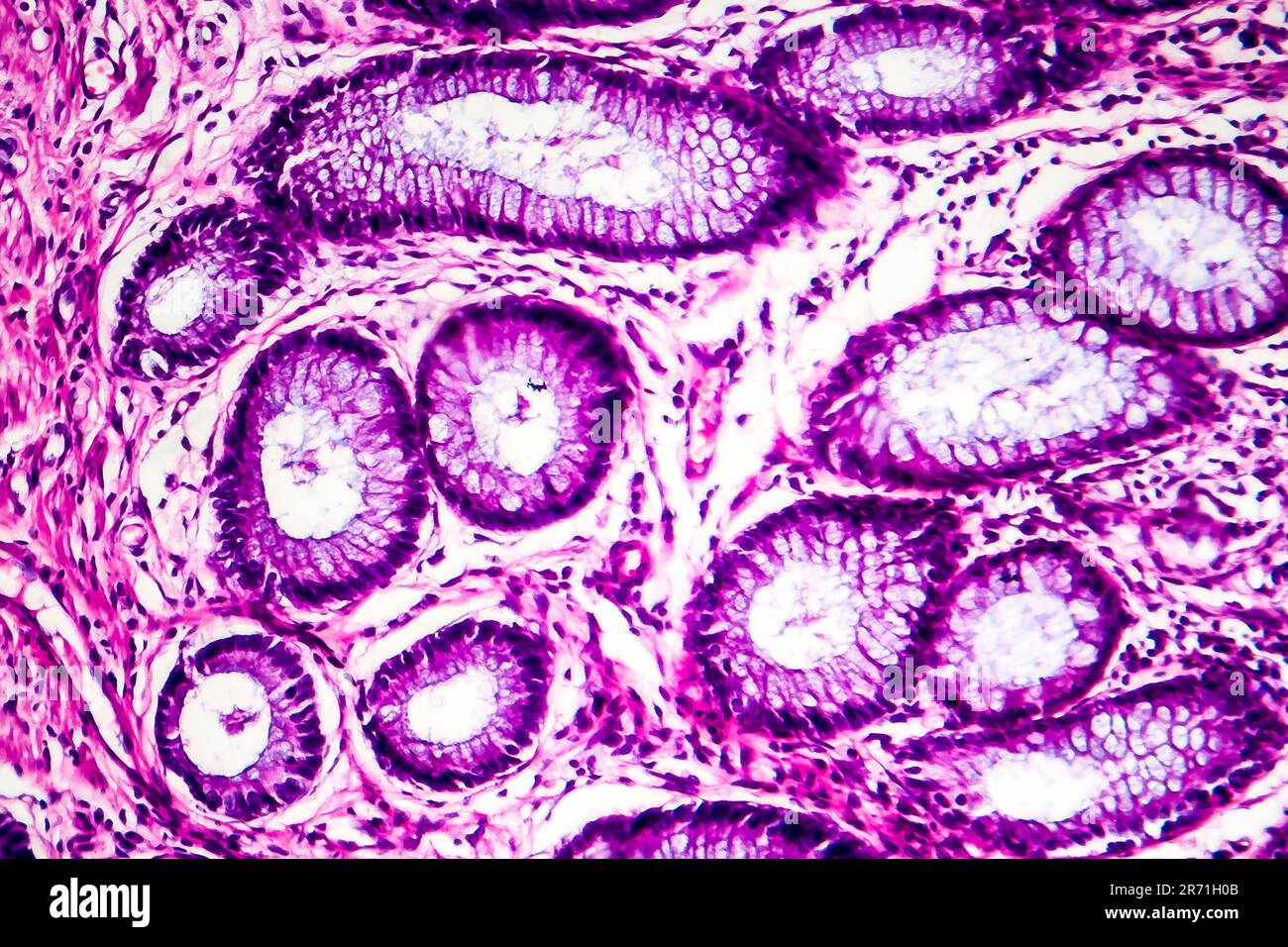 Well-differentiated intestinal adenocarcinoma, light micrograph, photo ...