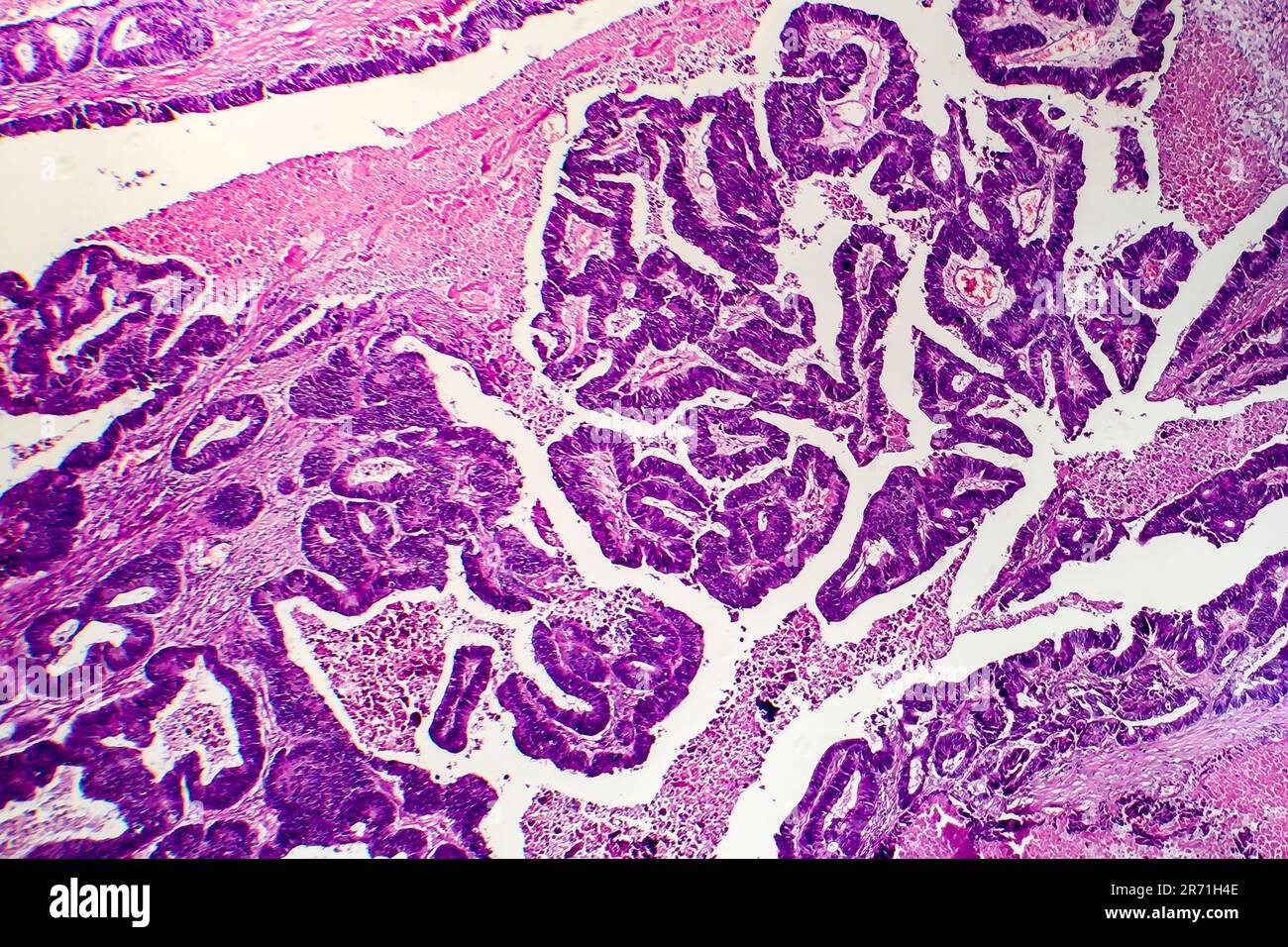 Differentiated intestinal adenocarcinoma, light micrograph, photo under ...