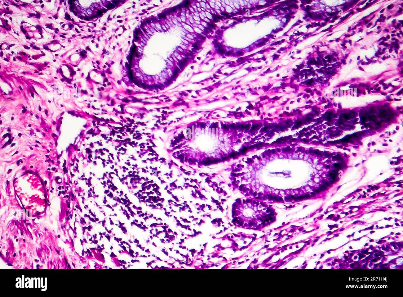 Well-differentiated intestinal adenocarcinoma, light micrograph, photo ...