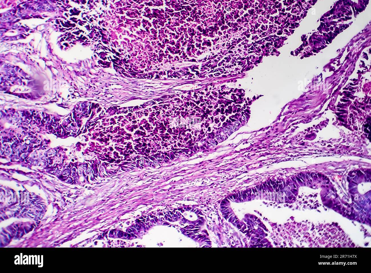Differentiated intestinal adenocarcinoma, light micrograph, photo under ...