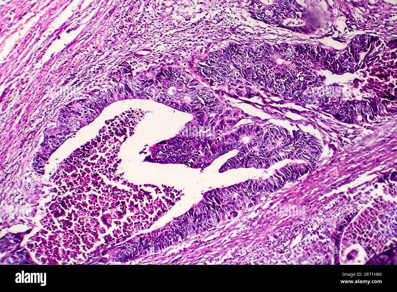 Differentiated intestinal adenocarcinoma, light micrograph, photo under ...