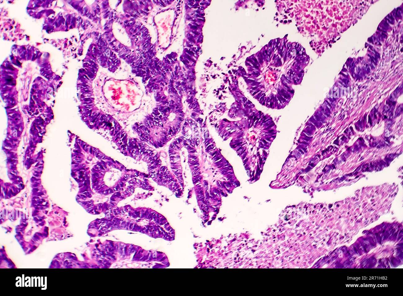 Differentiated intestinal adenocarcinoma, light micrograph, photo under ...
