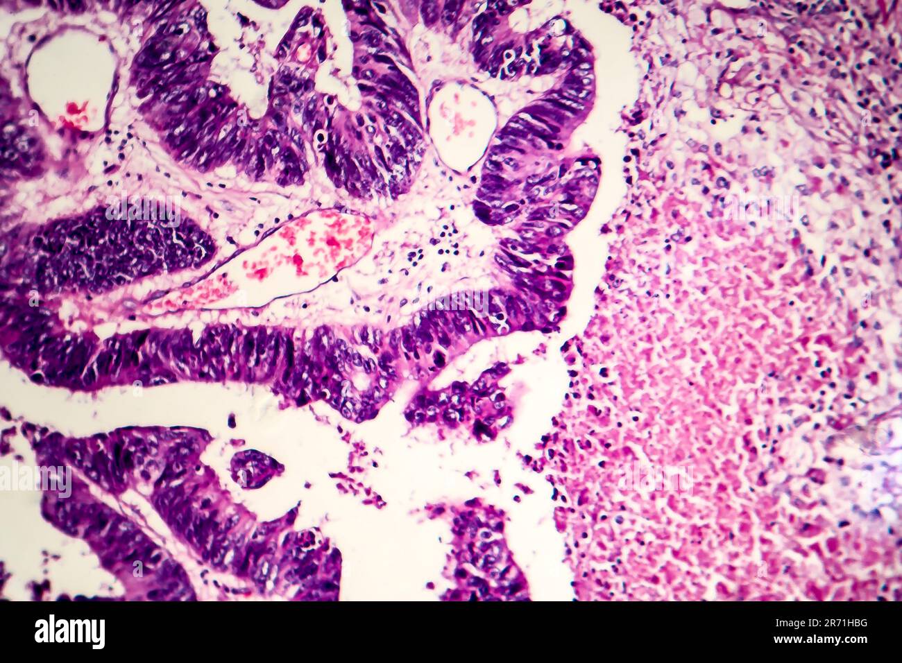 Differentiated intestinal adenocarcinoma, light micrograph, photo under ...