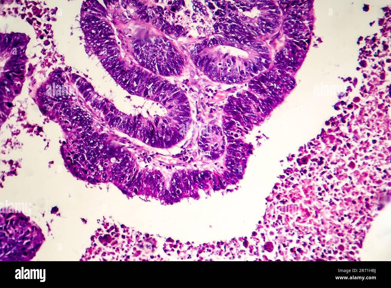 Differentiated intestinal adenocarcinoma, light micrograph, photo under ...