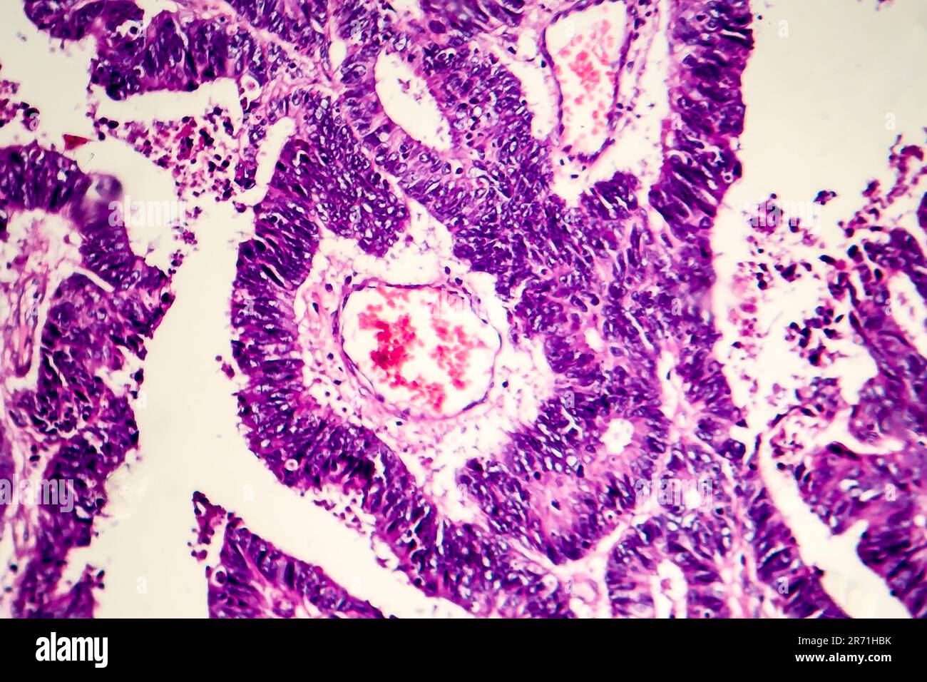 Differentiated intestinal adenocarcinoma, light micrograph, photo under ...