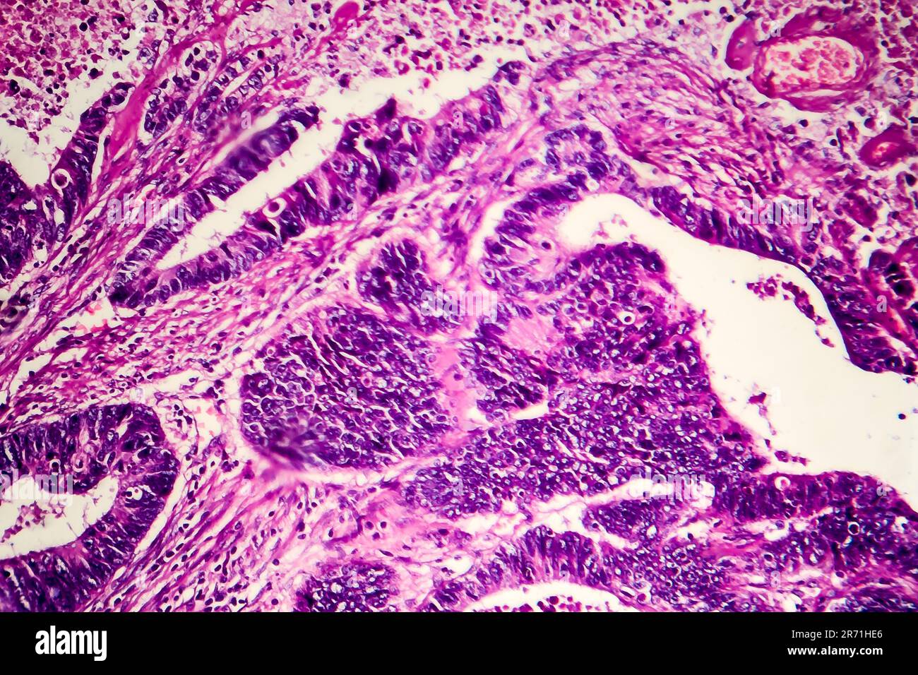 Differentiated intestinal adenocarcinoma, light micrograph, photo under ...