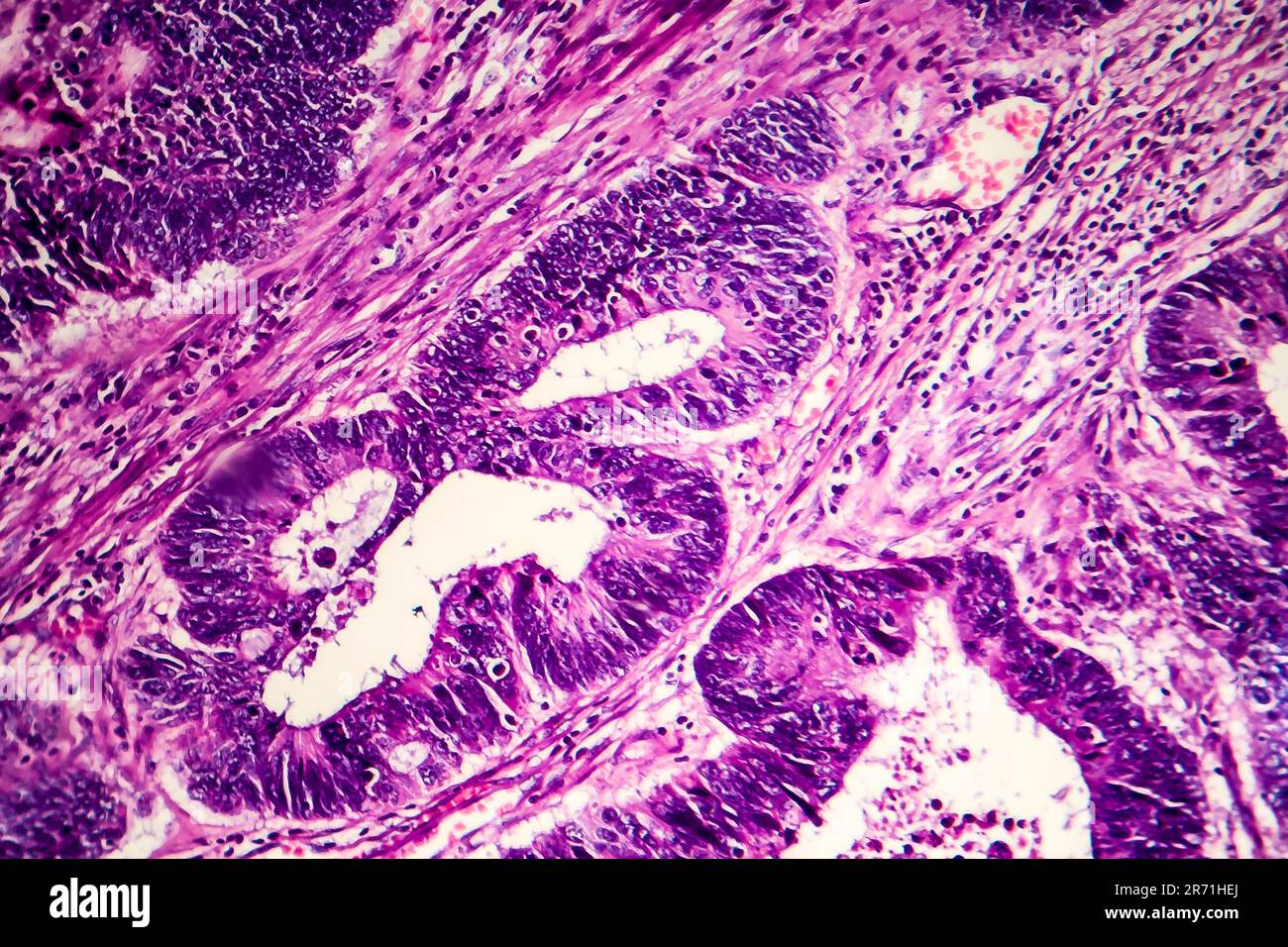 Differentiated intestinal adenocarcinoma, light micrograph, photo under ...