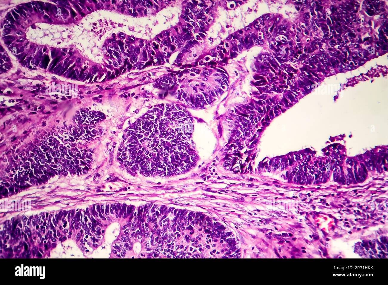 Differentiated intestinal adenocarcinoma, light micrograph, photo under ...
