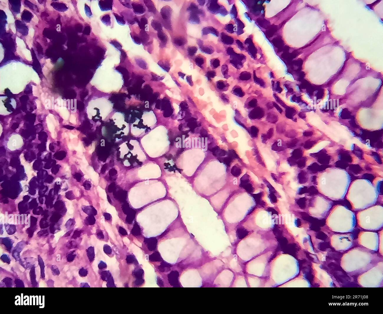 Bacillary dysentery, light micrograph, photo under microscope showing ...