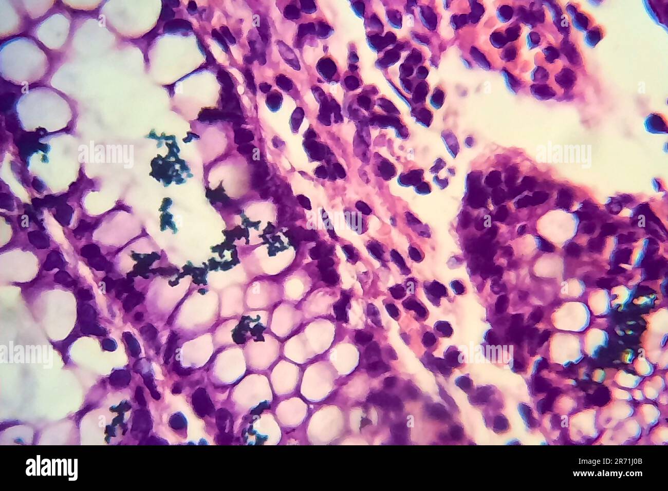 Bacillary dysentery, light micrograph, photo under microscope showing ...