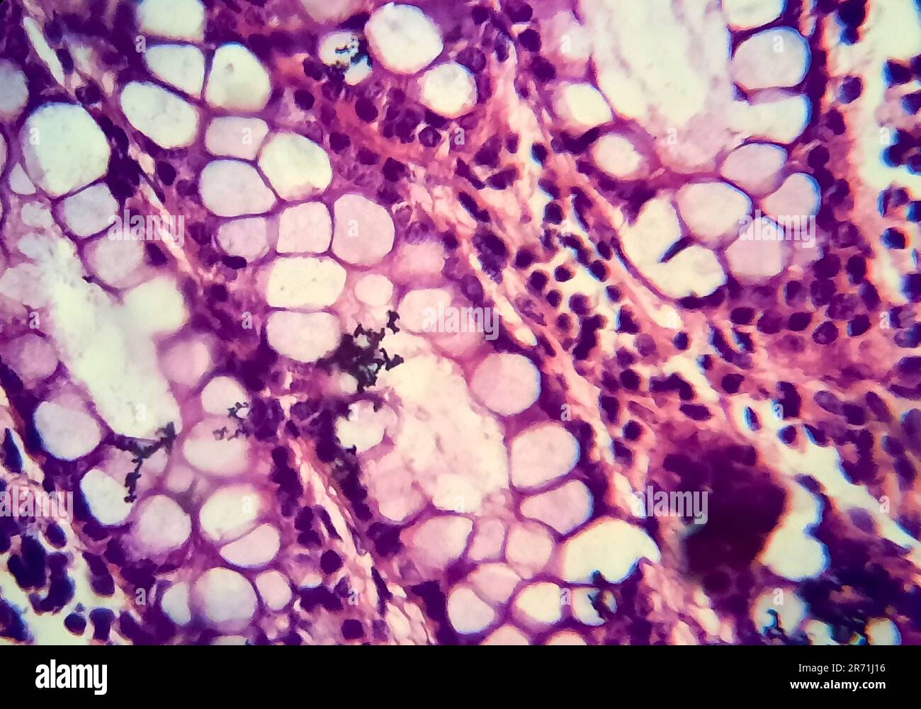 Bacillary dysentery, light micrograph, photo under microscope showing ...